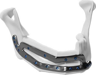 Patient-specific craniofacial plates | Customy